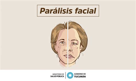 Parálisis Facial Cuáles son sus tipos y cómo deben tratarse