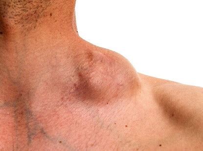 Lump On Neck Near Collar Bone