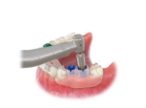 OneGuide Hiossen Implant