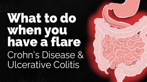 Ulcerative Colitis Symptoms Causes Treatment