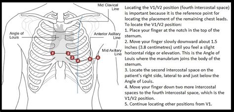 Telemetry Lead Placement Diagram