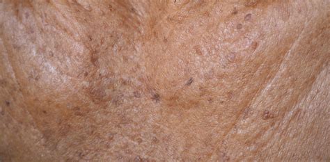 Seborrheic Keratosis Treatments Sagebrush Dermatology