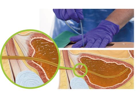 How To Catheterize Bactiguard
