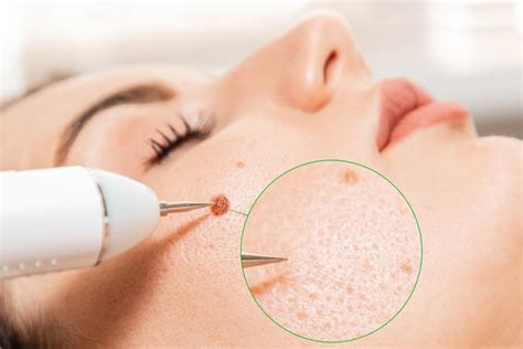 How To Remove Skin Tags Causes Treatments Watsons Philippines