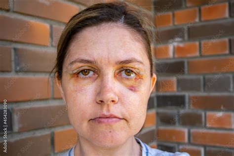 Double Eyelid Surgery Eyes Surgery Recover Period Immediately After