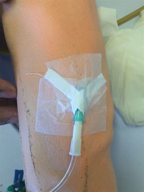 A Person With An Iv Hooked Up To Their Thigh