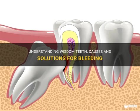 Understanding Wisdom Teeth Causes And Solutions For Bleeding MedShun