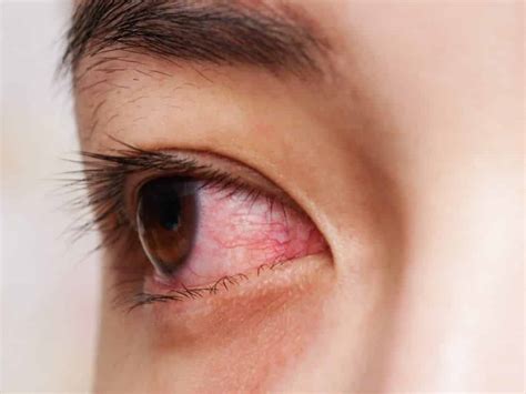 Qué es la CONJUNTIVITIS Área Oftalmológica Avanzada