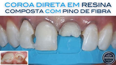 Coroa Direta Em Resina Composta Pina De Fibra YouTube