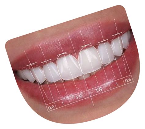 Diseño de sonrisa
