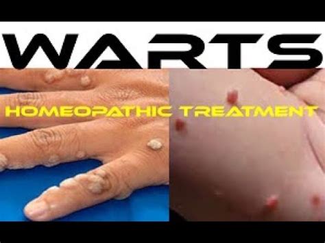 Homeopathic Medicine For Wart Homeopathic Warts Verruca Treatment