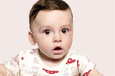 Okres inkubacji odry u dorosłych i dzieci czas jego trwania objawy