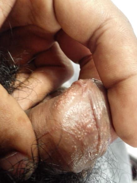 Granos En El Pene Ccm Salud