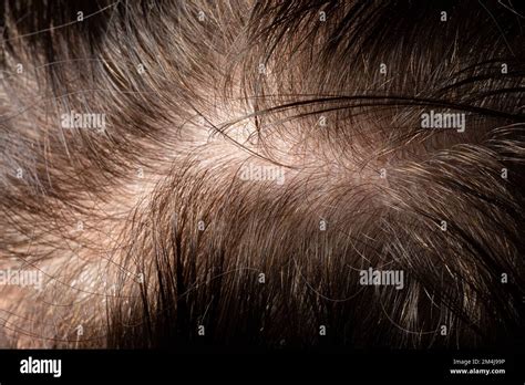 Female Scalp With Baldness And Hair Loss Problems Seborrheic