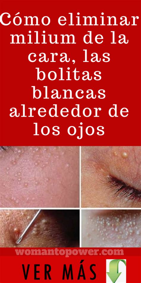 Cómo eliminar milium de la cara las bolitas blancas alrededor de los
