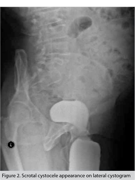 Figure 2 From A Rare Cause Of Inguinal Hernia Scrotal Cystocele