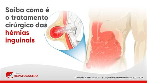 Saiba Como é O Tratamento Cirúrgico Das Hérnias Inguinais Clínica