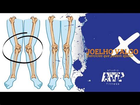 Joelho em valgo Exercícios que podem ajudar YouTube
