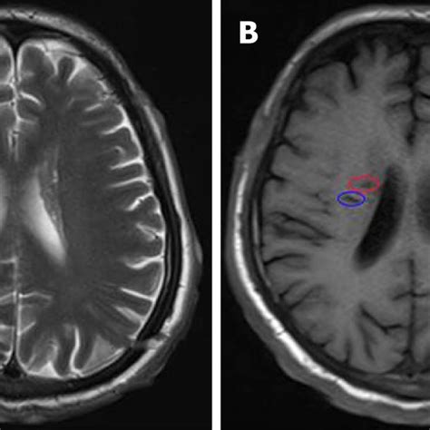 Magnetic Resonance Imaging Revealing Abnormal Hyperintense Lesions In