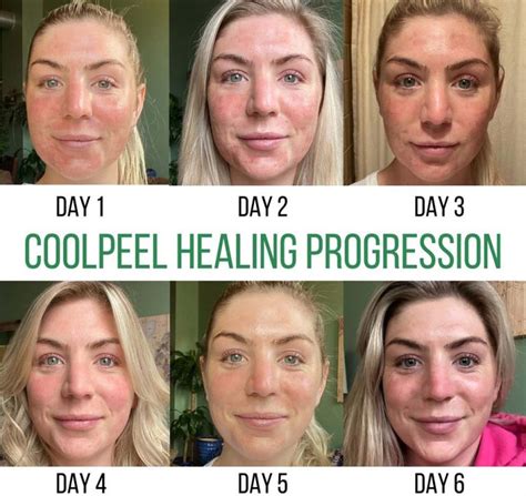 Laser Resurfacing Side Effects Risks Ultimate Guide