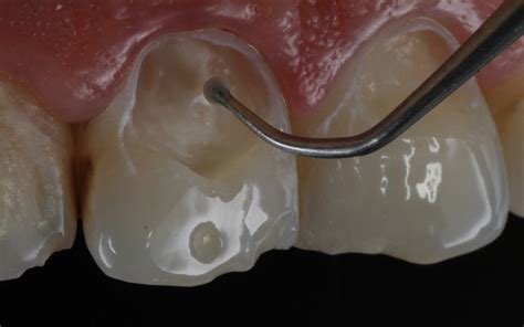Restaurações CL V em resina composta direta FGM Dental Group