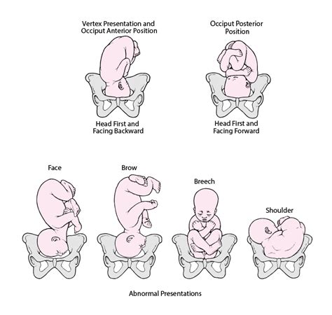 Figure Position And Presentation Of The Fetus Msd Manual Consumer Version