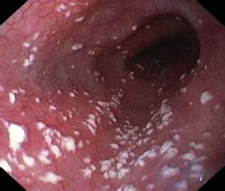 Pathology Of Upper Gi Tract Flashcards Quizlet