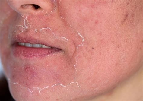 Peeling Qu Mico Axioma Estudi Dental