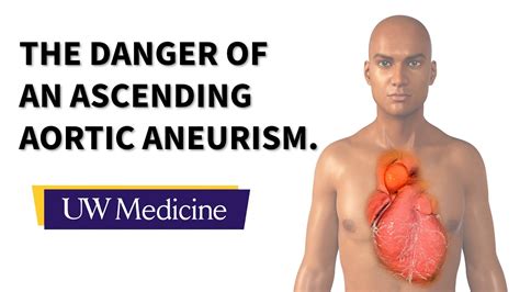 Surgeon Describes An Ascending Aortic Aneurysm UW Medicine YouTube