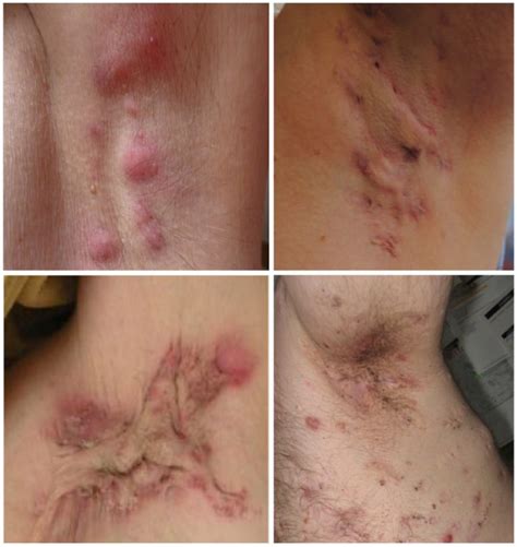 HIDRADENITIS SUPPURATIVA Stamford Skin Centre