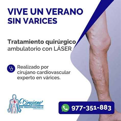 Qué tratamientos existen para las várices en las piernas Cirujano