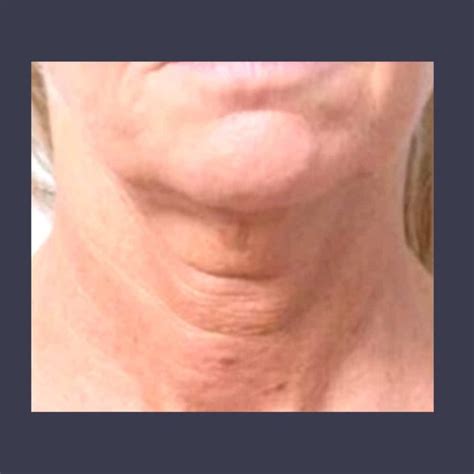 Profhilio Cream Biostimulator Bio Remodelling Injections Sydney