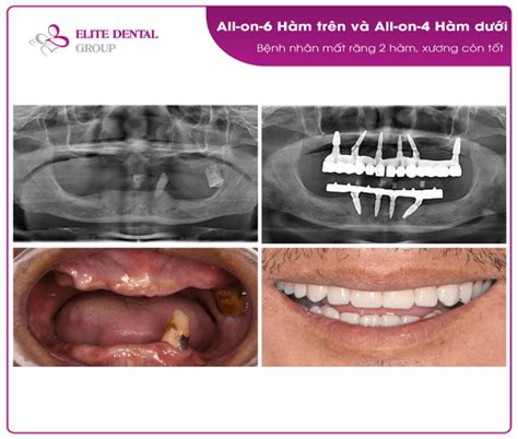 Full Mouth Dental Implants Definition Cost And Procedure