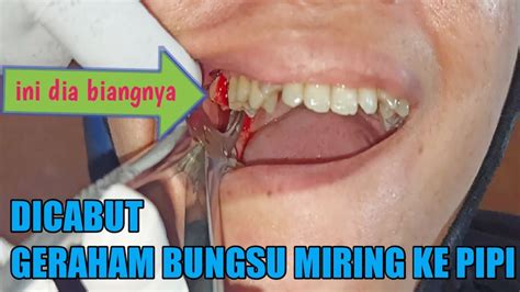 Pencabutan Geraham Bungsu Atas Yang Sangat Miring Ke Pipi Youtube