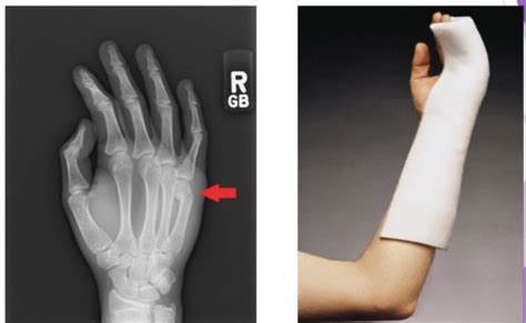 Casting And Splinting Flashcards Quizlet