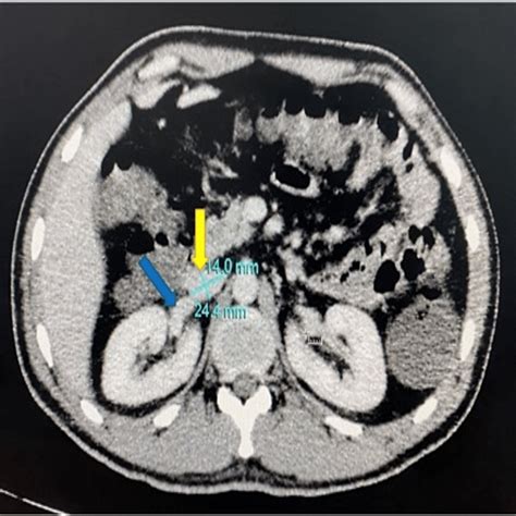Evaluation Of Normal Inferior Vena Cava Diameters In The Indian Adult