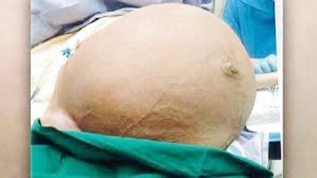 fibrome ventre gonflé Fibrome et gonflement du ventre