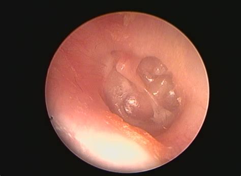 Normal Right Tympanic Membrane