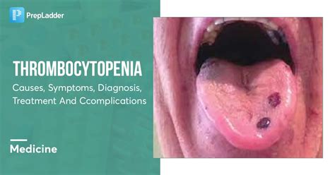 Thrombocytopenia Causes Symptoms Diagnosis Treatment And Complications