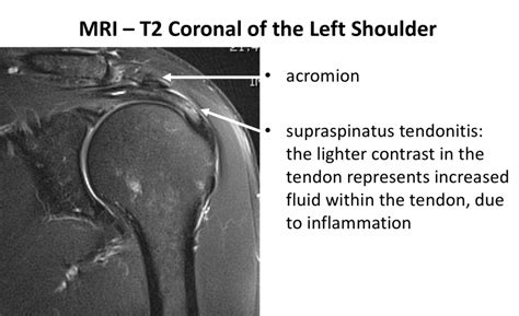 Fig B Mri Ss Tendonitis Cambridge Shoulder