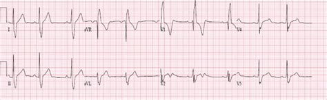 Estudios Mediante Impulsos El Ctricos Electrocardiograma Ekg