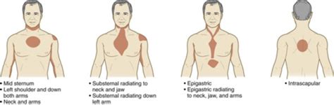 Acute Coronary Syndrome Flashcards Quizlet