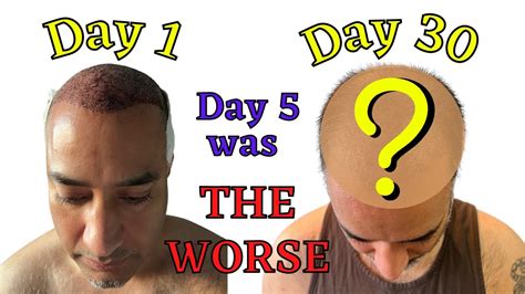 AMAZING One Month HAIR TRANSPLANT RESULT One Month After FUE Hair