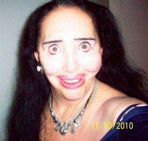 11 People Who Experienced EPIC PLASTIC SURGERY FAILS With Images