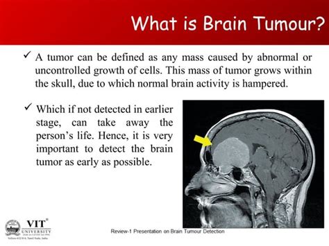 brain tumor detection by scanning mri images using filtering techniques