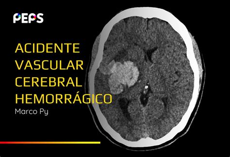Acidente Vascular Cerebral Hemorrágico PEPS
