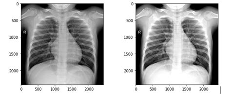 Github Vishal Khot Pneumonia Detector