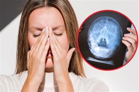Przewlekłe zapalenie zatok torbiel zatok mucocele objawy i leczenie