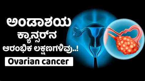 Ovarian Cancer Symptoms and Causes ಅಡಶಯ ಕಯನಸರ ಬಗಗ ನಮಗನ