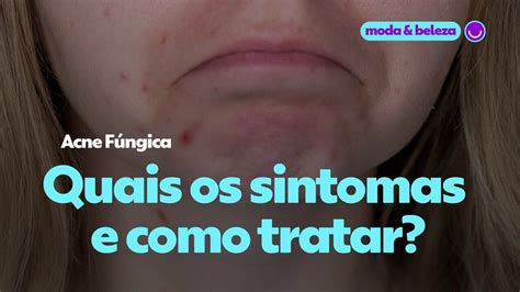 Vídeo Acne Fúngica o que é quais os sintomas e como tratar Moda